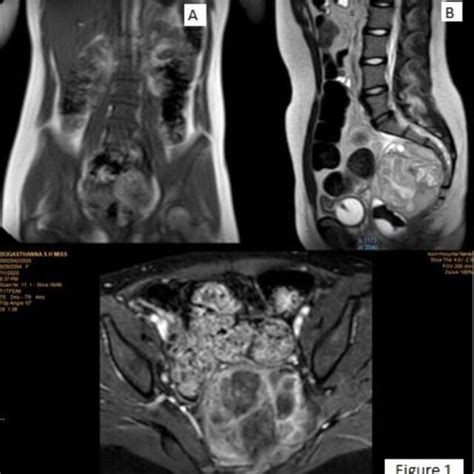 Mri Scan Of Abdomen And Pelvis Showing The Extent Of The Tumour Within
