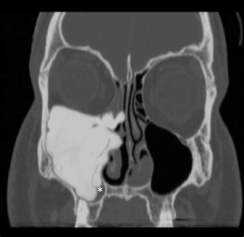 Treatment Of Fibro Osseous Lesions At The Pediatric Skull Base