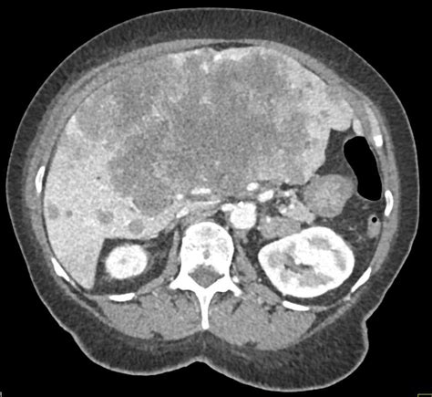 Cholangiocarcinoma Radiopaedia