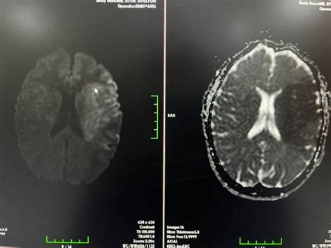 90 Prefrontal Cortex Foto Stok Potret And Gambar Bebas Royalti Istock