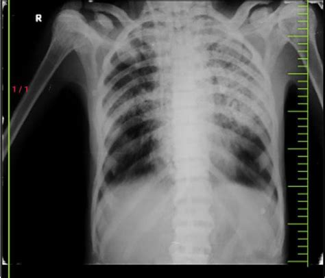 Aki On Ckd Stage V Urosepsis Resolvin B L Consolidation Of Lungs Pneumonia Altered Sensorium