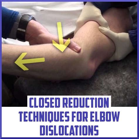 Closed Reduction Techniques For Elbow Dislocations Sports Medicine Review