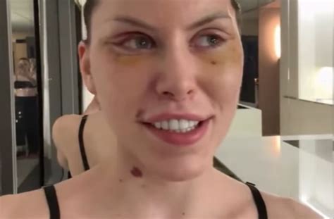 Julia Von Stein Zrobiła Sobie Operację Twarzy Jak Wygląda Tydzień Po