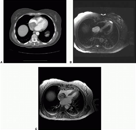 Cardiac Masses Radiology Key
