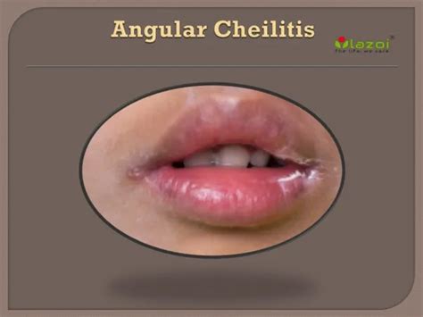 Ppt Cracked Corners Of Mouth Cheilitis Angular Cheilitis Remedy