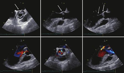 Transesophageal Echocardiogram Midesophageal Views At 49° A And 118° Download Scientific
