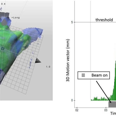Left Patient Setup With Surface Guided Radiation Therapy Right Download Scientific Diagram