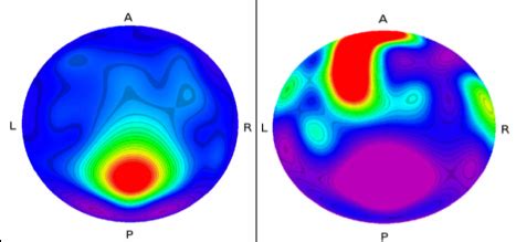 Topographic Maps Generated From EEG Data Projected Onto A Surrogate Download Scientific Diagram