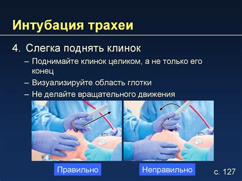 Интубация трахеи