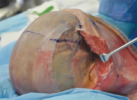 Facial Allograft Technique In Facial Reconstruction Herman The Shocker