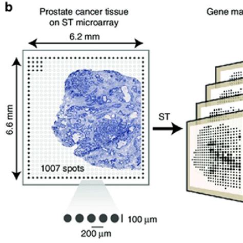 Spatial Transcriptomics St Study Design In Prostate Cancer A