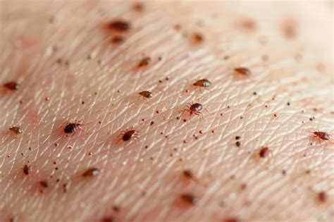 Multiple Bed Bug Bites Skin Premium Ai Generated Image