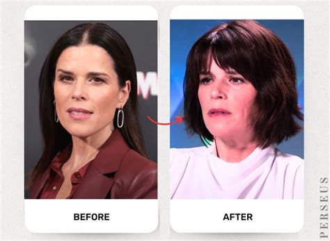 Celebs With Hair Loss How Do They Cope Perseus Hair Care