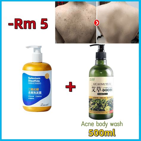 Anti Dandruff Shampoo Selenium Sulfide Shampoo二硫化硒去屑洗发水300ml Anti Dandruff Anti Itch Remove Acne