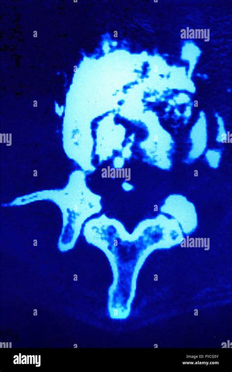 VERTEBRAL FRACTURE SCAN Stock Photo Alamy