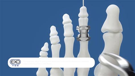 Cpt Code For Hammertoe Correction With Tenotomy At Donald Hammond Blog