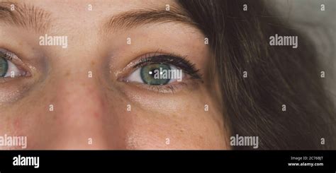 Woman With Under Eye Bag Puffy Eye Of Girl Showing Eyes Bags Womans