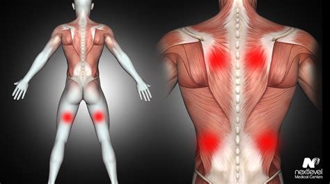 Everything You Need To Know About Trigger Point Therapy