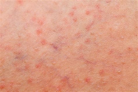 What Is Folliculitis And How Is It Treated