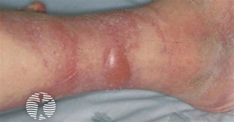 Pitting Oedema Image