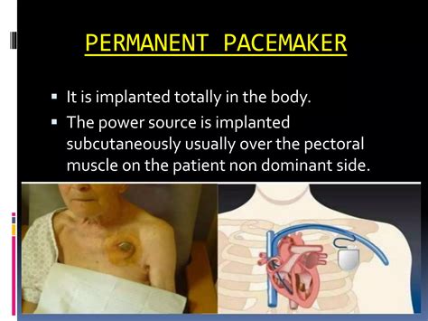 Pacemaker Powerpoint Presentation Med Surg Pptx