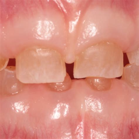 Dentinogenesis Imperfecta Dr Ellie Nadian
