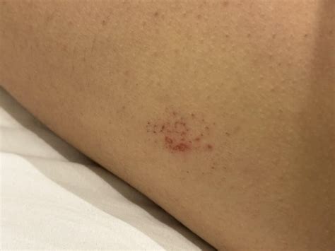 Inner Thigh Rash Itches What Is It Rdermatologyquestions