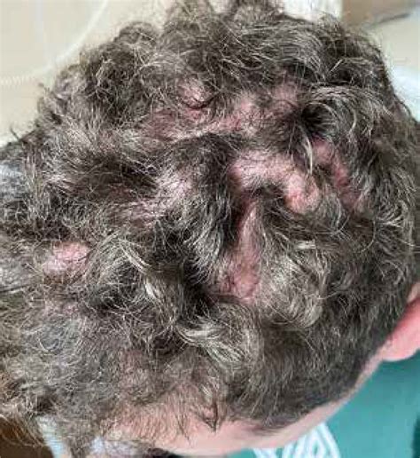 Scalp Cellulitis