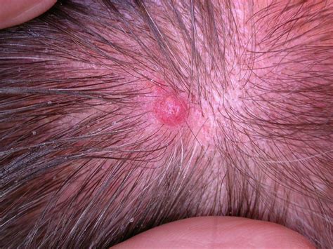 Recurring Scab On Scalp In The Same Spot How To Treat