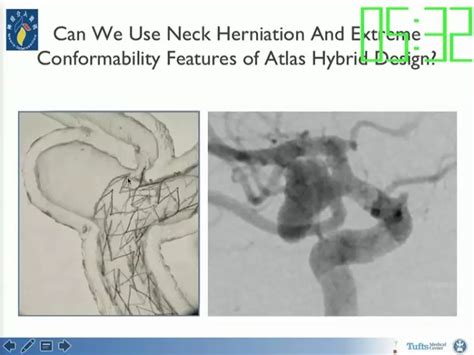 Adel Malek：neuroform Atlas支架在颅内动脉瘤治疗中的应用丨ocin2017精彩回顾 脑医汇