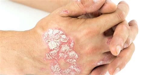 Psoriasis en placas imágenes síntomas y gravedad Salud Tudo