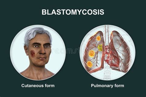 Clinical Forms Of Blastomycosis 3d Illustration Stock Illustration