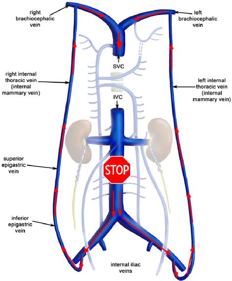 Figure 12 From Congenital Absence Of Inferior Vena Cava Semantic Scholar