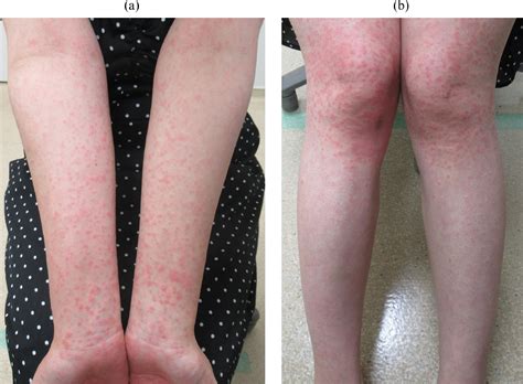 Skin Rash Following Amoxicillin Treatment European Journal Of