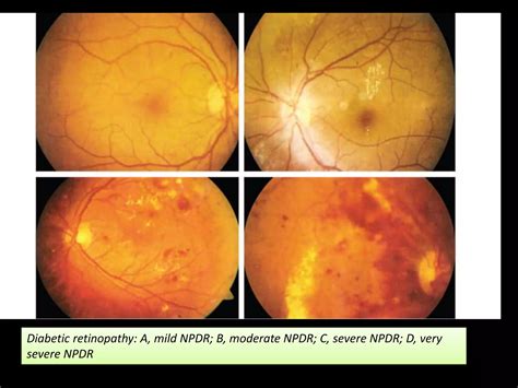 Quick Review On Diabetic Retinopathy Ppt
