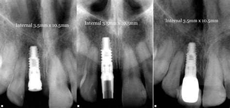 Biohorizons Internal Implante Dental Spotimplant
