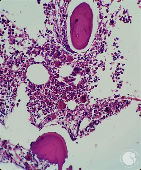Immune Thrombocytopenic Purpura Itp Bone Marrow Biopsy View 6