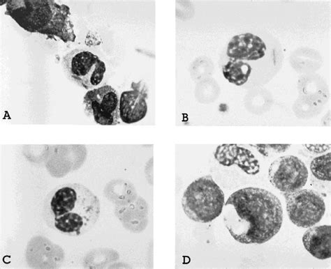 Haematological Features And Treatment Outcome In Acute Myeloid Download Scientific Diagram
