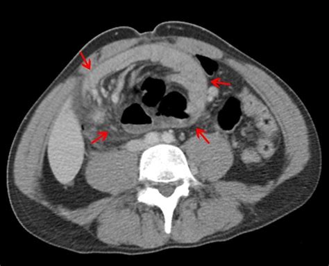 A Computed Tomography Section Showed A Portion Of The Transverse Colon