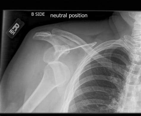 Sports Medicine Stats Shoulder Dislocations Dr Geier