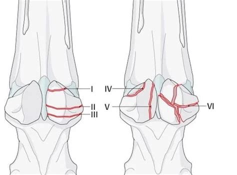 Sesamoid Fractures Robert Sheinberg Dpm Weston Fl Podiatrist