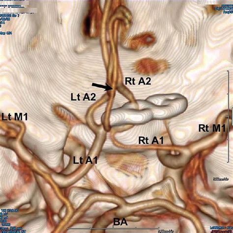 Surgical Neurology International