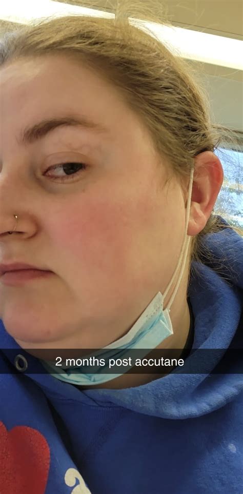 Im Wearing A Tinted Spf In The First 3 Pictures I Didnt Think My