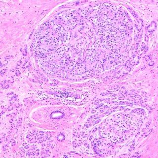 A And B Duodenal Tumor Adjacent To Pancreatic Heterotopia Composed Of