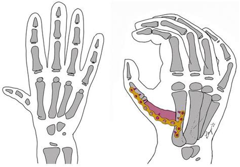 Michaela Zheng On Linkedin An Alternative Treatment Option For Blauth Iii B Thumb Hypoplasia—thumb