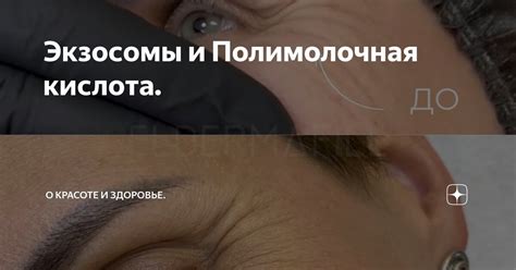 Экзосомы и Полимолочная кислота О красоте и здоровье Дзен