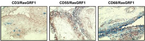 Representative Double Staining Of Rheumatoid Arthritis Synovial Tissue