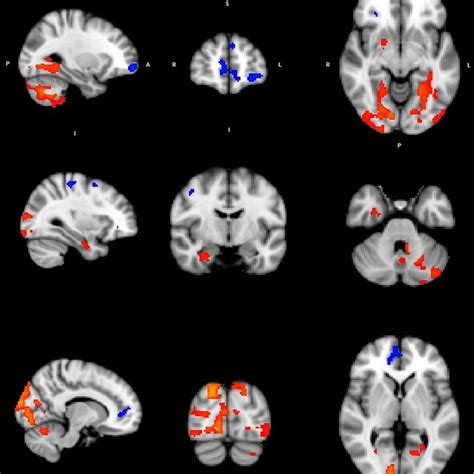 Image Representing Tendencies In The Voxel Based Morphometry Analysis Download Scientific