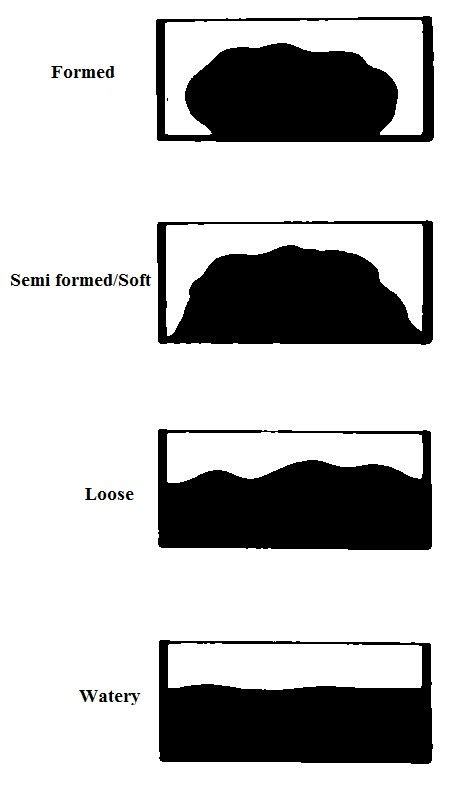 Macroscopic Appearance Of Stool ¥ Mucoid And Bloody Specimen When