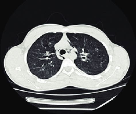 Diffuse Pneumomediastinum On Computed Tomography Ct Of The Second